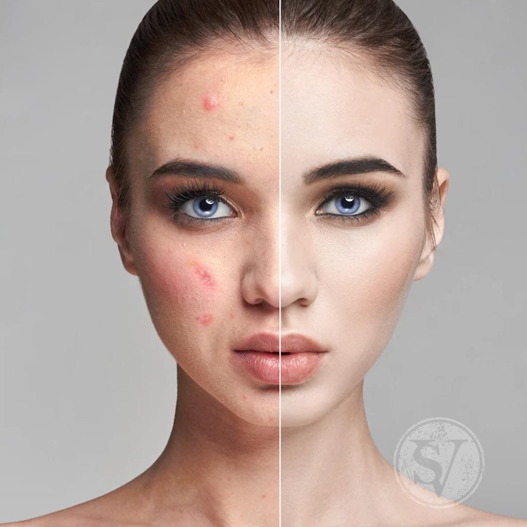 Makeup Glamour: How to Cover Every Type of Acne | StoriesViews